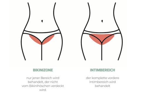 Dauerhafte Haarentfernung Bikinizone - DERMAPURA